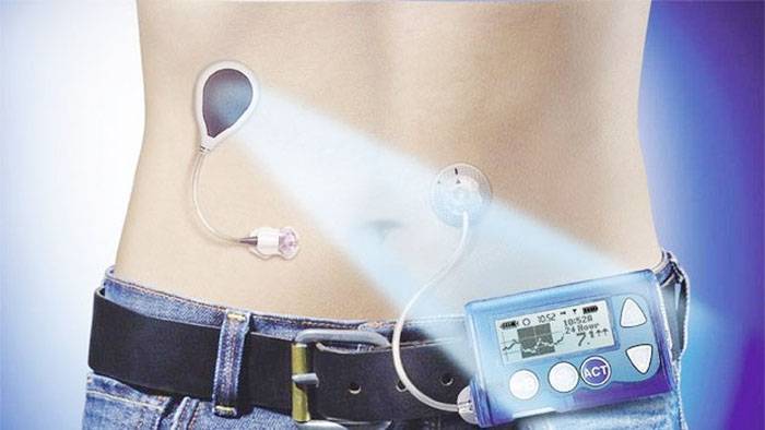 Este páncreas artificial controla la diabetes tipo 1 – El Heraldo